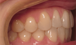 Virtual Consultation | Mattiacio Orthodontics